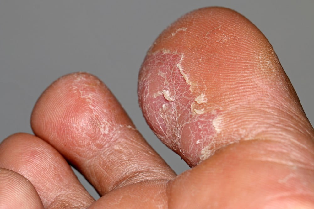 Can Work Boots Cause Athlete’s Foot? - Best Boots Hub